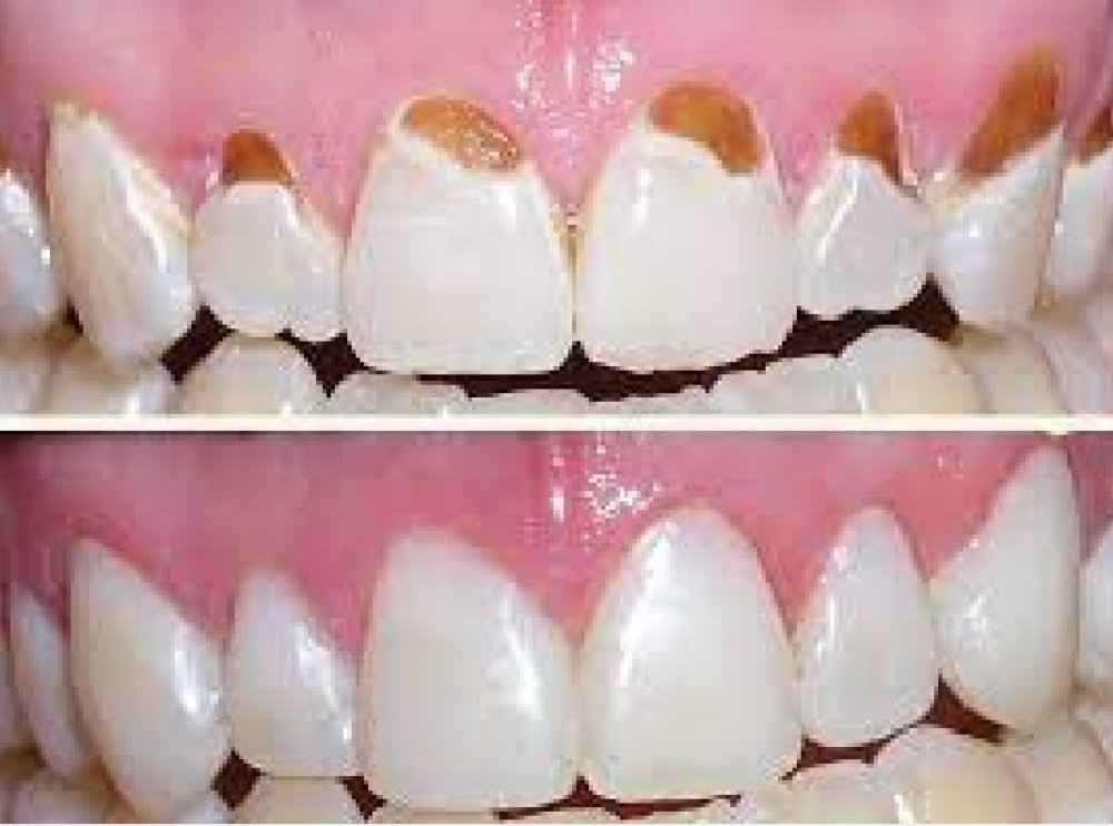 Swollen Gum Behind Back Tooth No Wisdom Teeth: Causes, symptoms, treatments