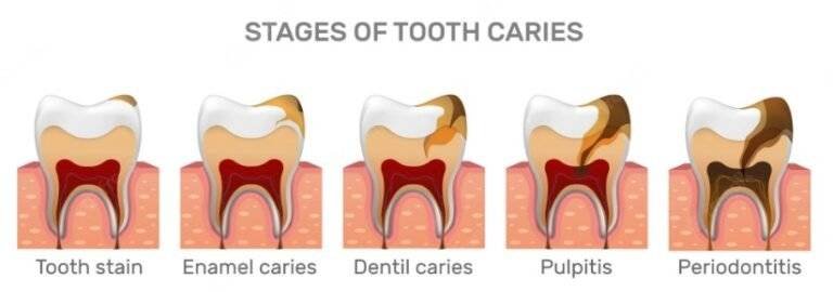 5 Dangers of Pulling an Abscessed Tooth: Tooth Abscess Stages with ...