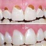 Tooth Extraction Blood Clot Fell Out: Here's What You Need to Know - Go ...