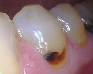 Tooth Decay at Gum Line with Pictures 2023 - Go Fix Teeth