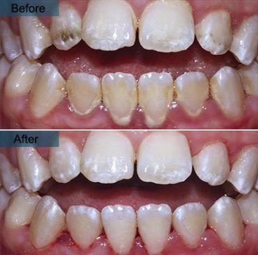 Deep Cleaning Teeth Before and After with (Pictures) is it safe? - Go ...
