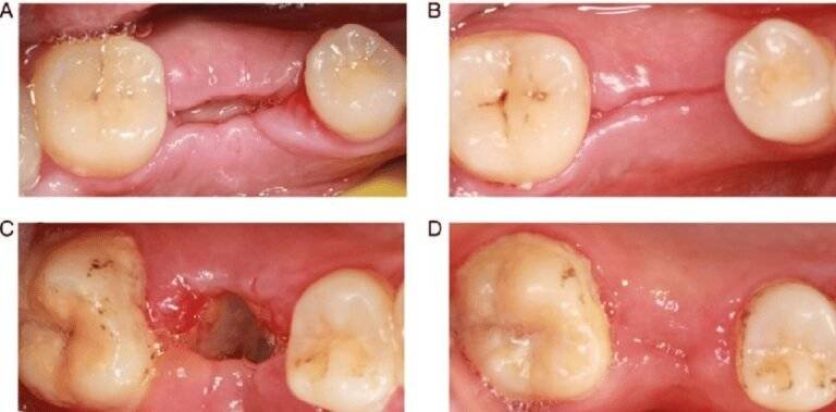 Day by Day Tooth Extraction Healing Stages with Pictures 2023 - Go Fix ...