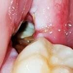 Tooth Extraction Blood Clot Fell Out: Here's What You Need to Know - Go ...