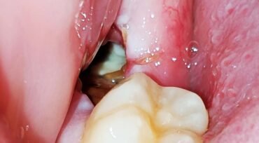 Normal Socket After Tooth Extraction With Pictures 2023 - Go Fix Teeth