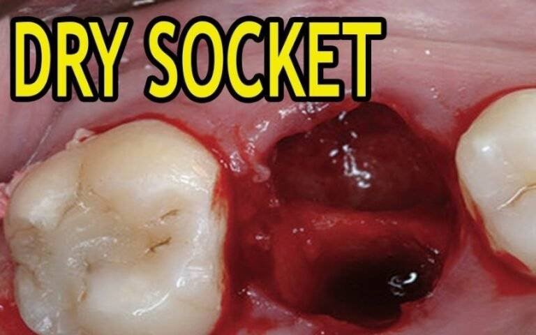 Normal Socket After Tooth Extraction With Pictures 2023 - Go Fix Teeth