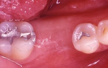 Normal Socket After Tooth Extraction With Pictures 2023 - Go Fix Teeth