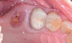 Pictures of Granulation Tissue After Tooth Extraction: Pictures and ...