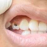 Tooth Extraction Blood Clot Fell Out: Here's What You Need to Know - Go ...